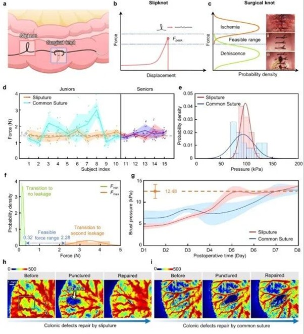 ZJU’s “slipknot” research featured in Nature: a single suture tackles ...